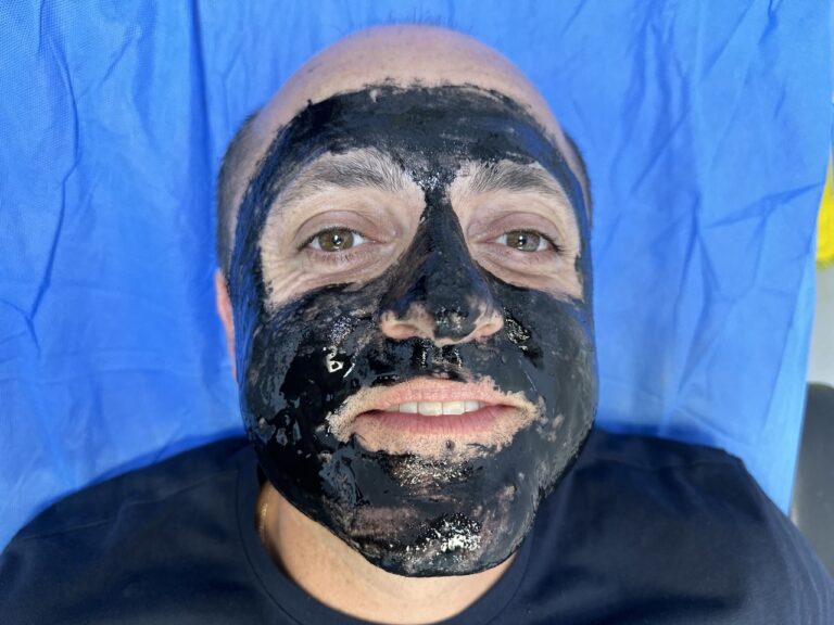 Nevus de Becker. Dermatología, Cirugía. Tratamiento Láser 🤩