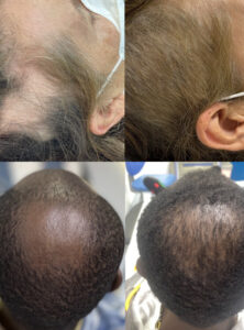 Alopecia tratamiento en Clínica Merced