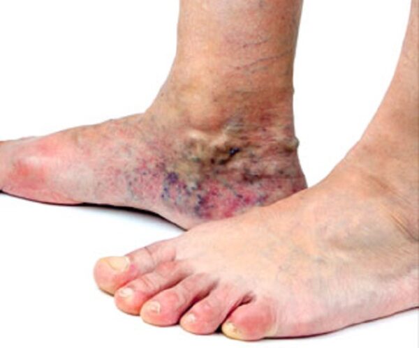 Pié Diabético. Tratamiento Médico y Cirugía Vascular ☺️