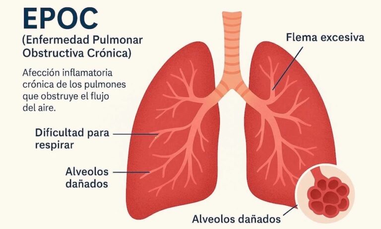 EPOC. Médico Broncopulmonar 🤩🤩